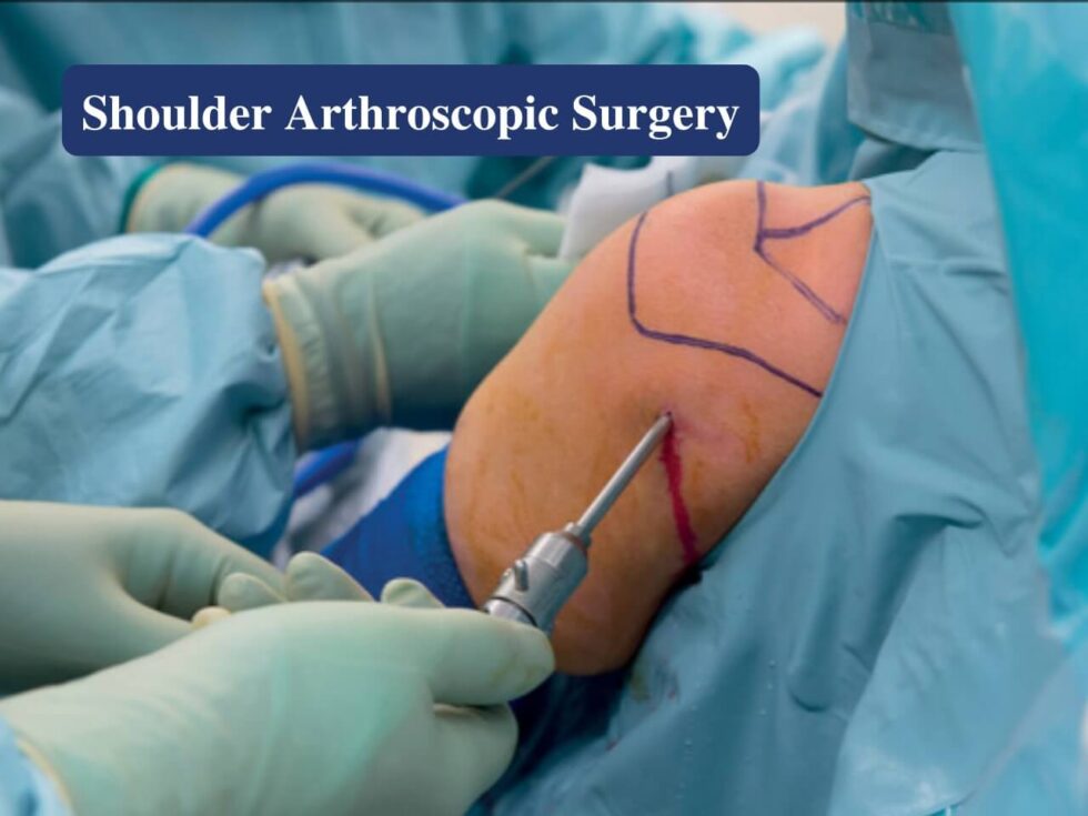 Shoulder Arthroscopy Pain Management: Relief & Healing Guide
